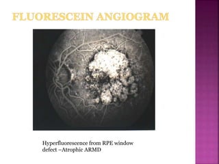 Age related macular degeneration | PPTX