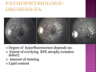 Age related macular degeneration | PPTX
