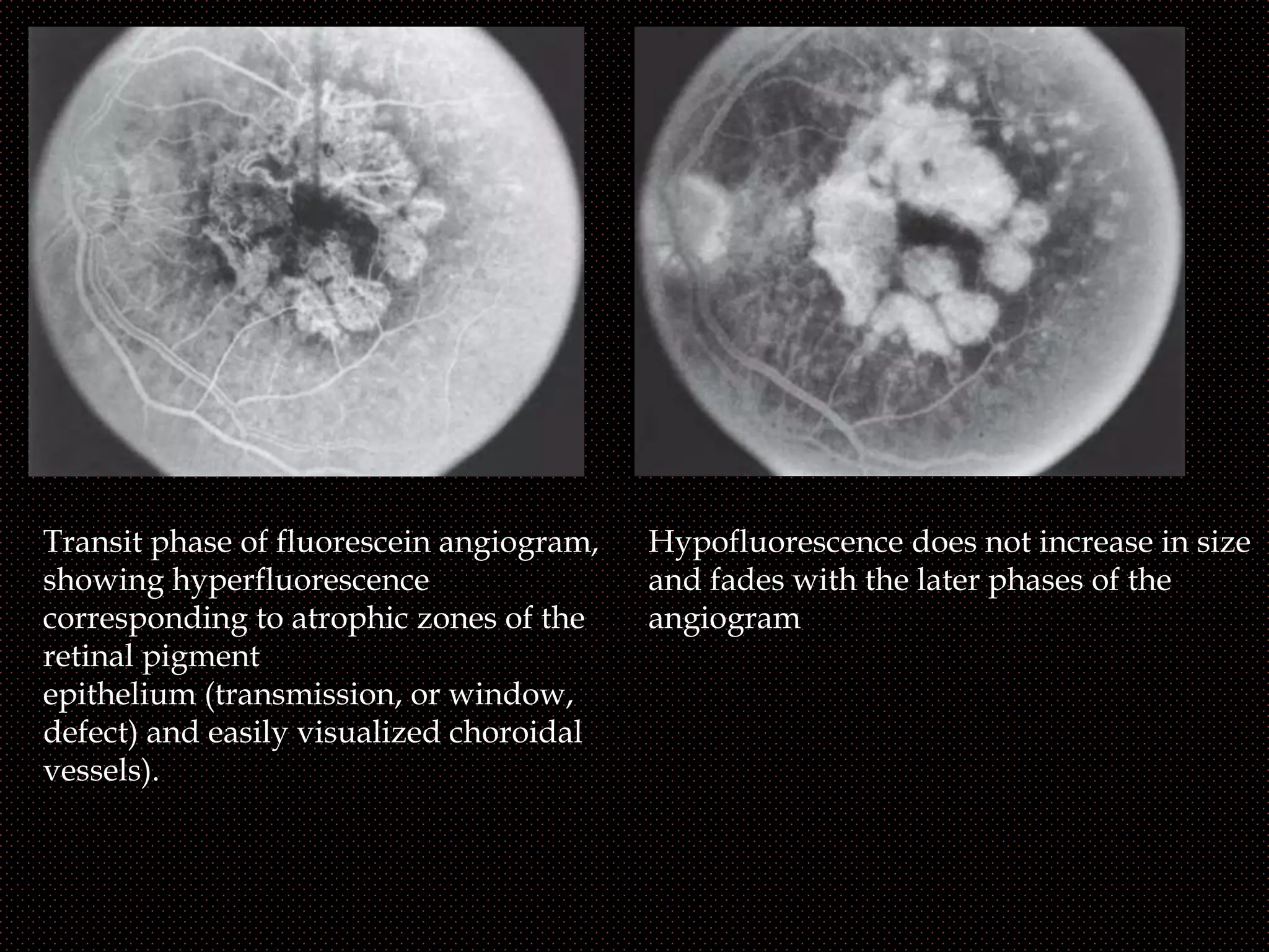 Age related macular degeneration | PPTX