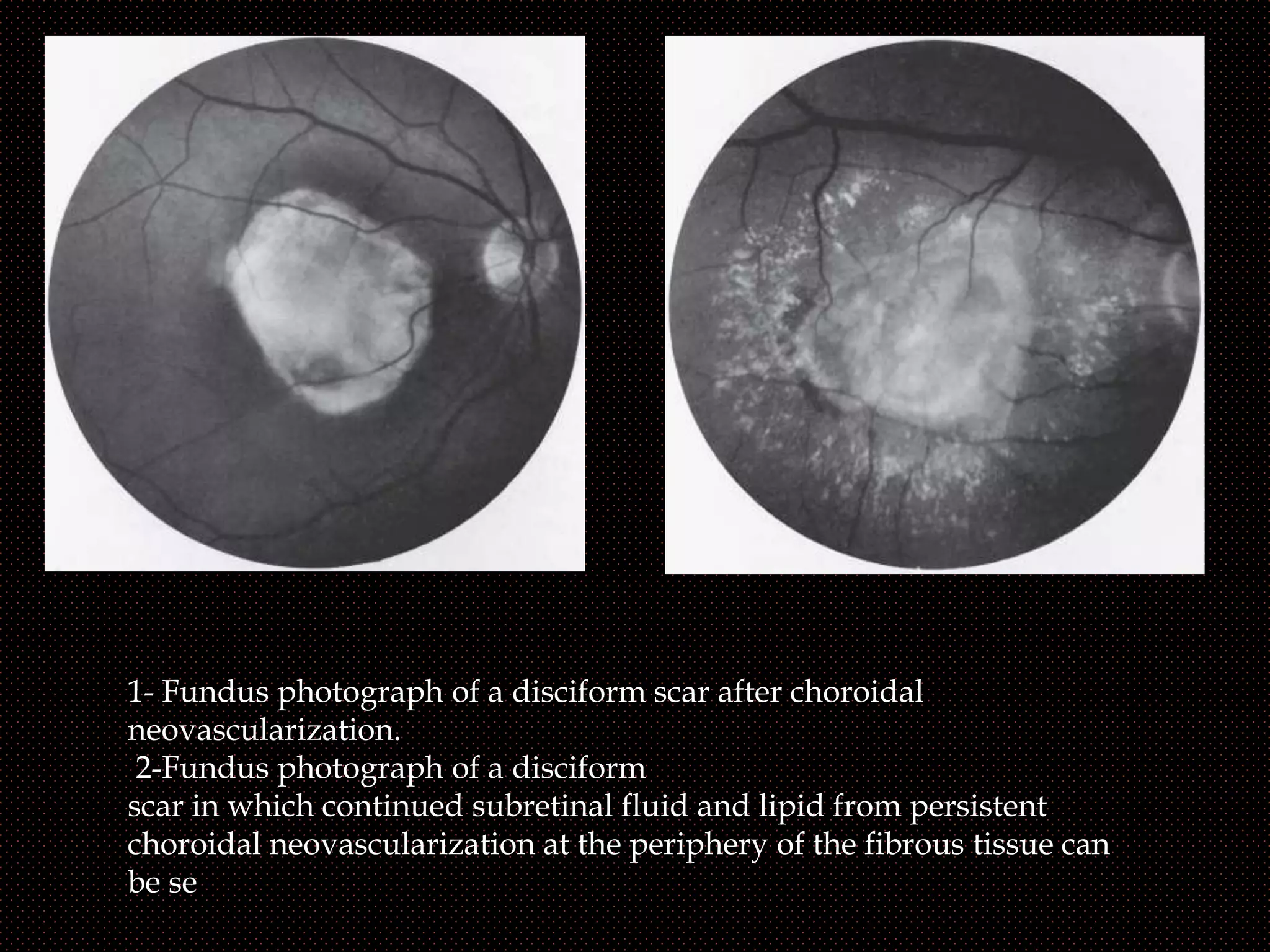 Age related macular degeneration | PPTX