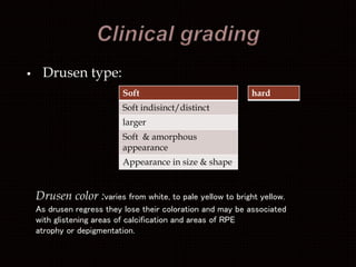 Age related macular degeneration | PPTX