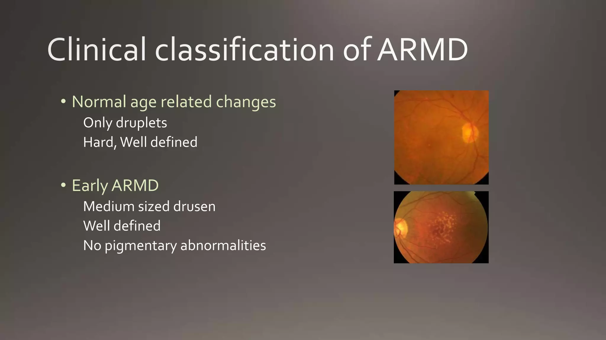 Age related macular degeneration | PPTX