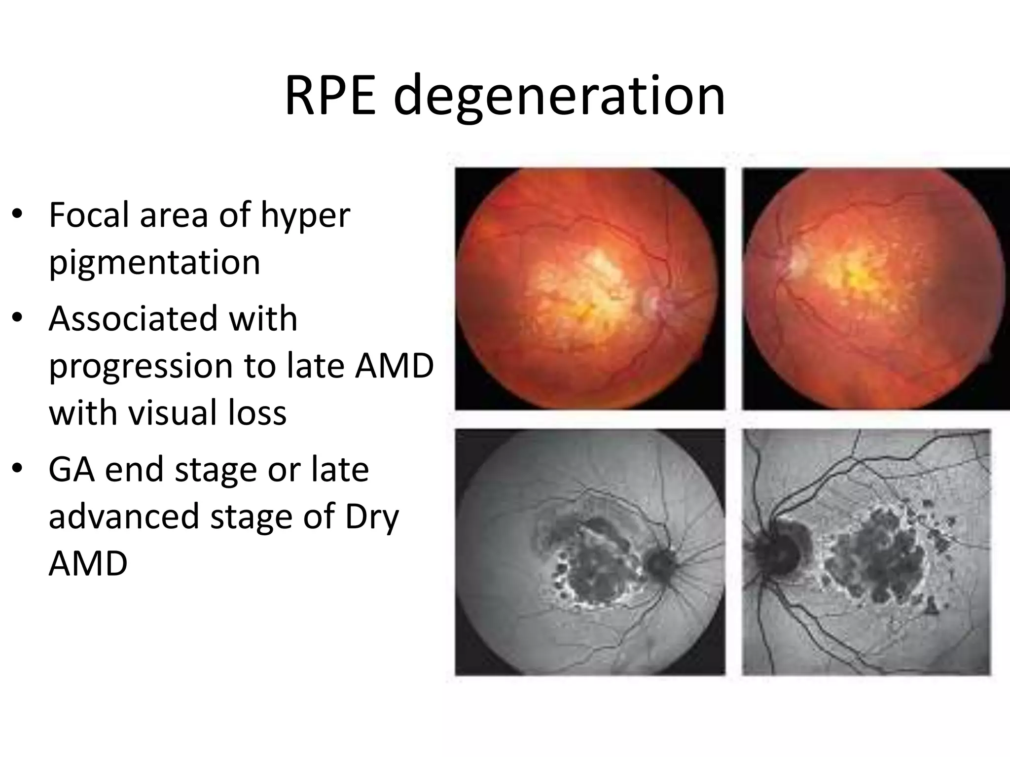 Age related macular degeneration | PPTX