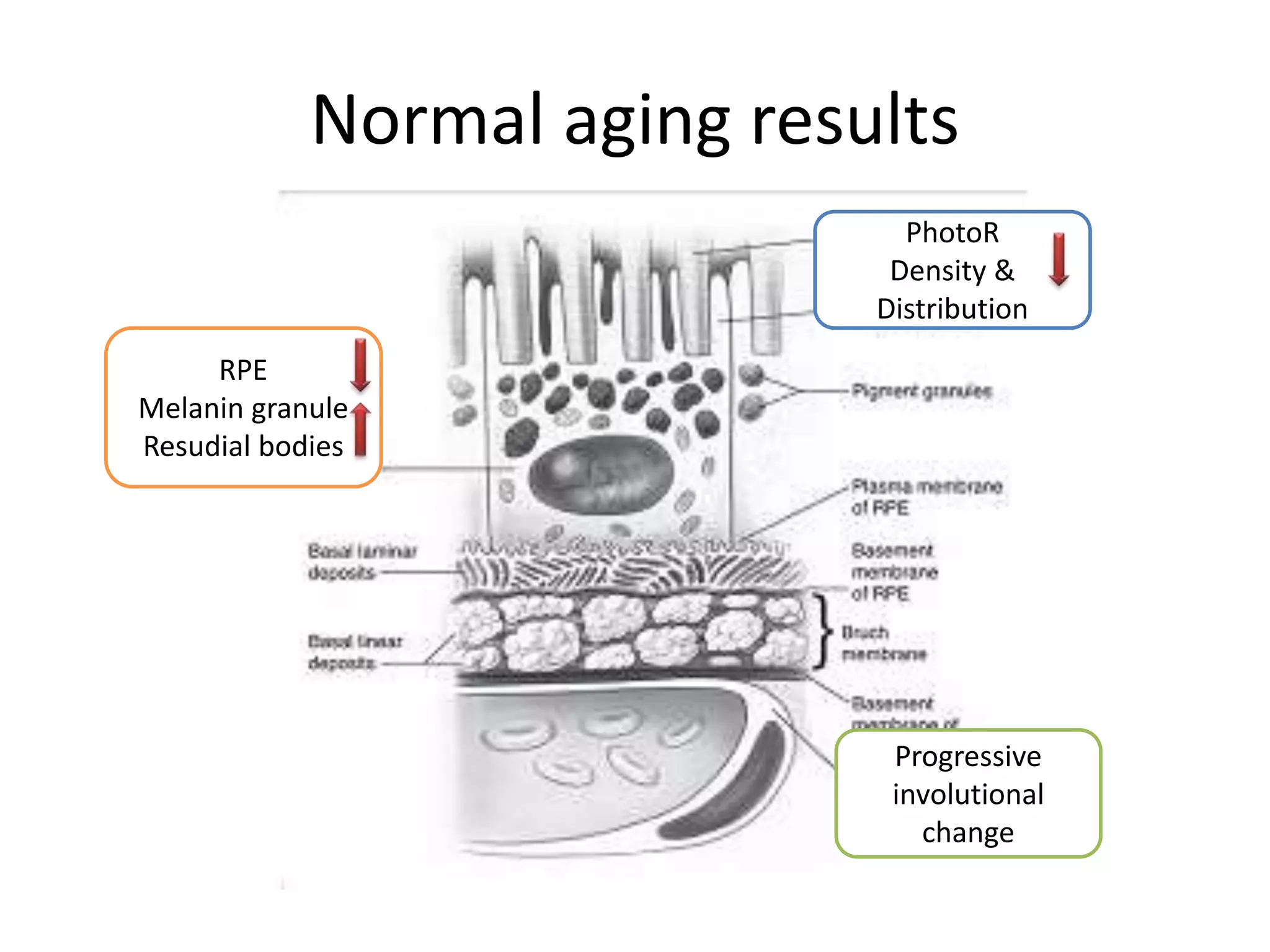 Age related macular degeneration | PPTX