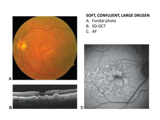 Age related macular degeneration | PPTX