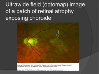 Age related macular degeneration ( | PPTX