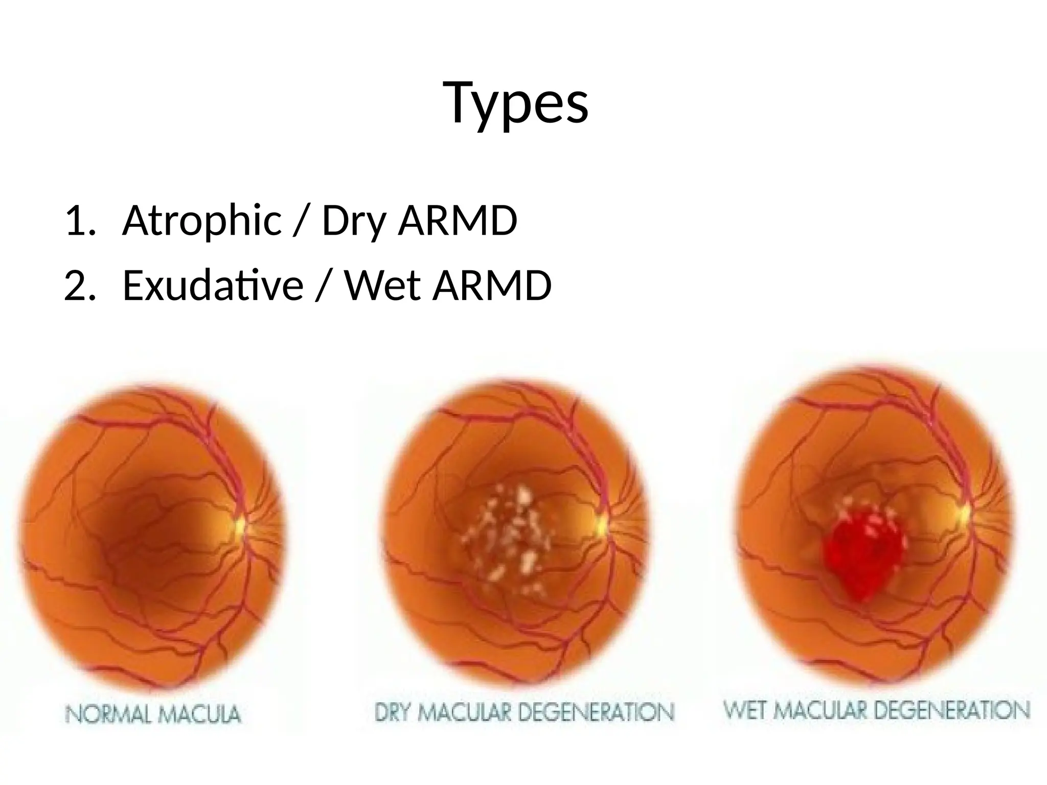 Age Related Macular Degeneration Armd Pptx