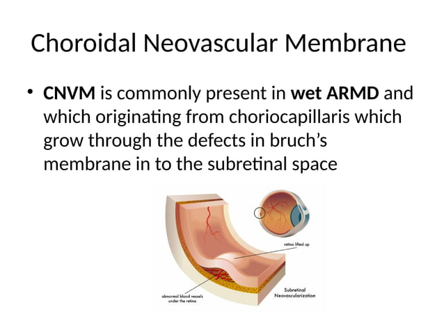 Age Related Macular Degeneration (ARMD).pptx