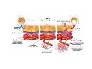 Age Related Macular Degeneration (ARMD).pptx
