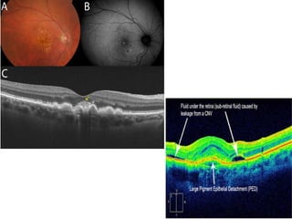 Age Related Macular Degeneration (ARMD).pptx
