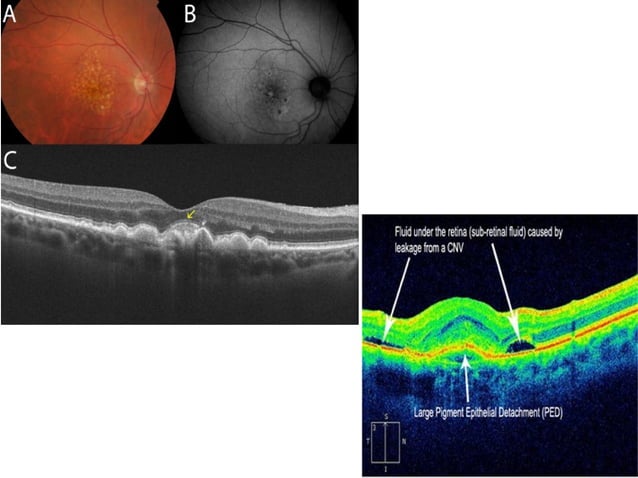 Age Related Macular Degeneration Armd Pptx