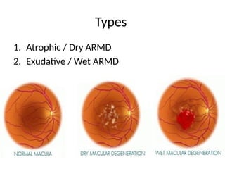 Age Related Macular Degeneration (ARMD).pptx