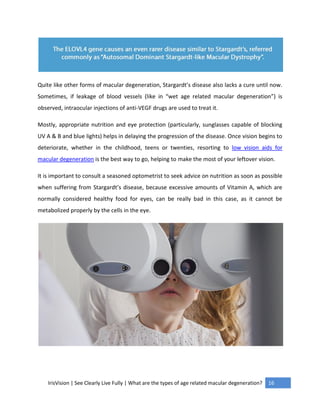 Age related macular degeneration by iris vision | PDF