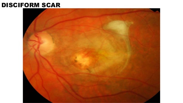 Age related macular degeneration nitin