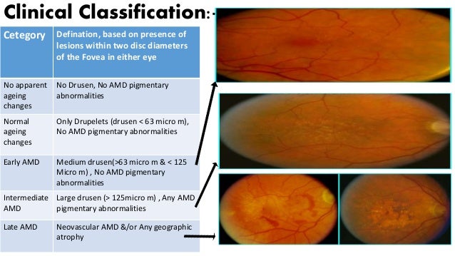 Age related macular degeneration nitin