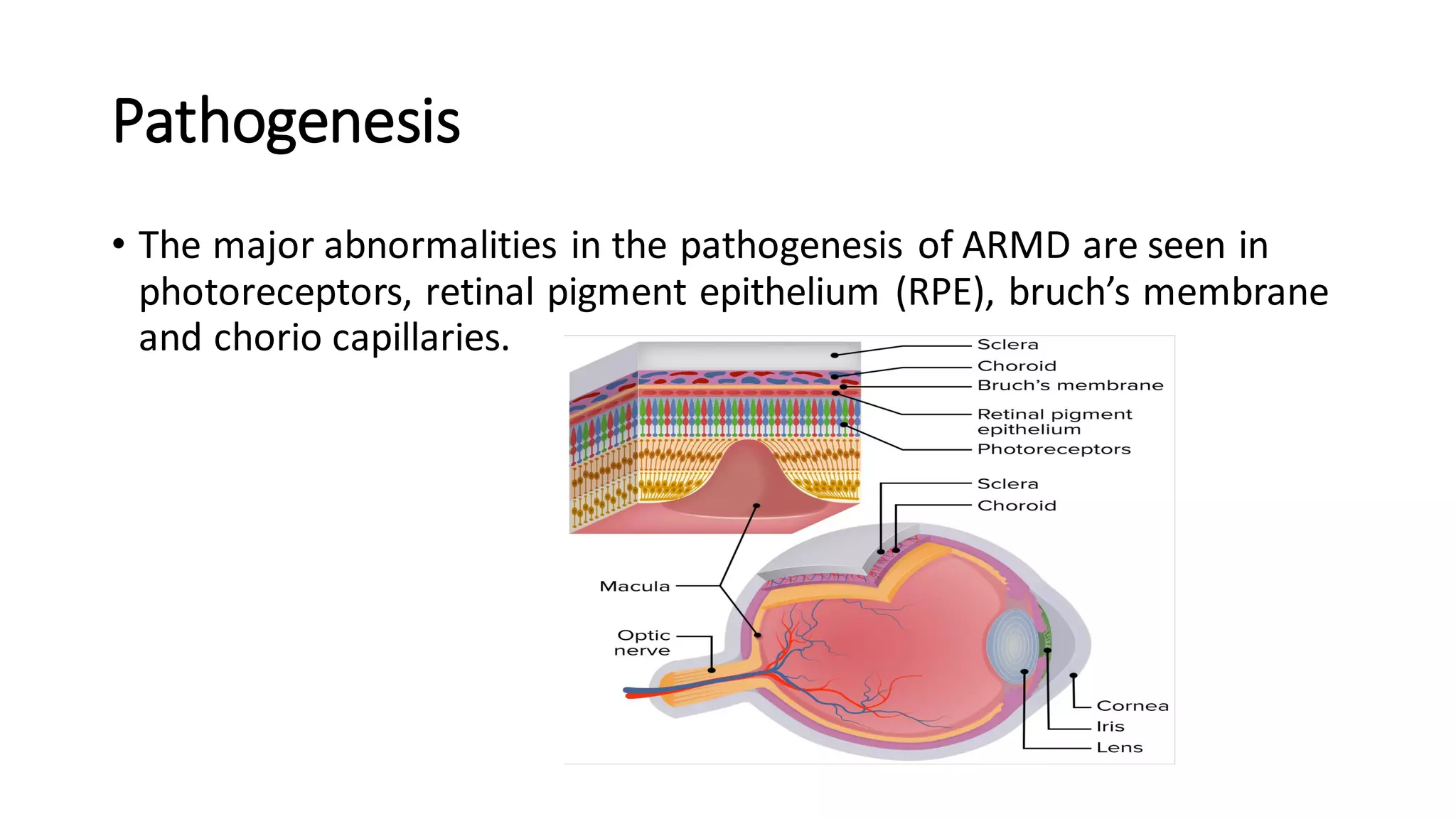 AGE RELATED MACULAR DEGRNERATION(ARMD).pdf