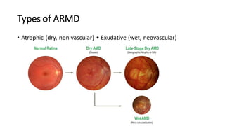 AGE RELATED MACULAR DEGRNERATION(ARMD).pdf