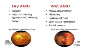 AGE RELATED MACULAR DEGRNERATION(ARMD).pdf