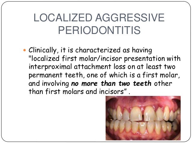 Aggresive periodontitis