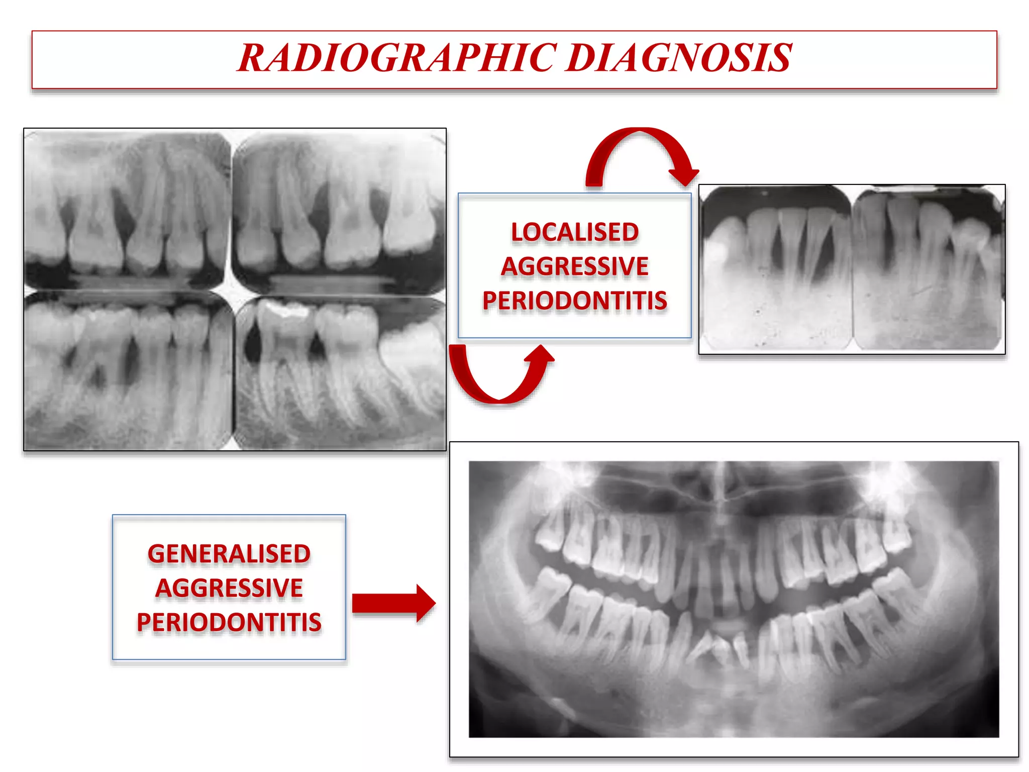 Aggresive periodontitis | PPTX