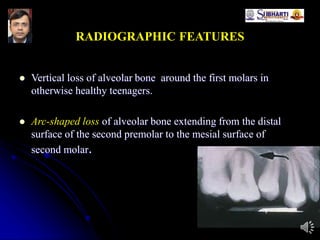 AGGRESSIVE-PERIODONTITIS-2020723122950.ppt