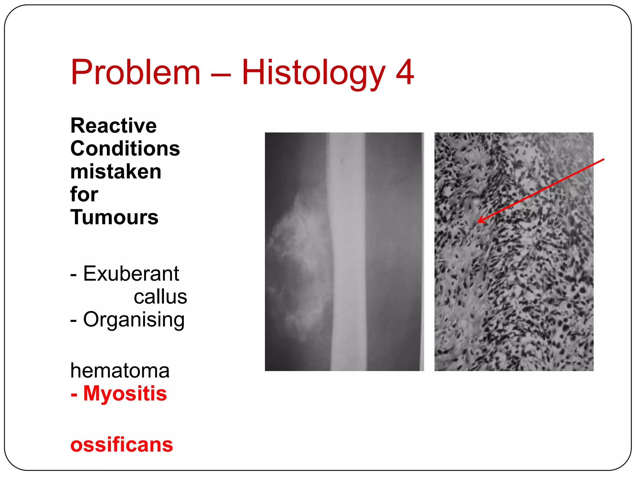 Aggressive & malignant bone tumours an overview | PPTX
