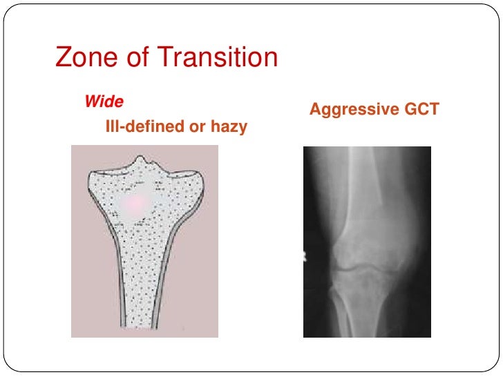Aggressive & malignant bone tumours an overview