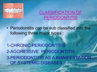 Aggressive periodontitis | PPT
