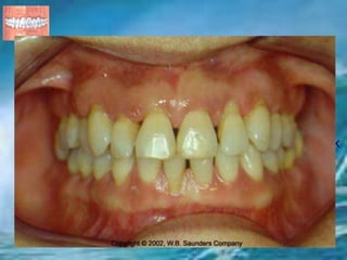 Aggressive periodontitis | PPT