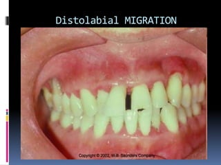 Aggressive periodontitis | PPT