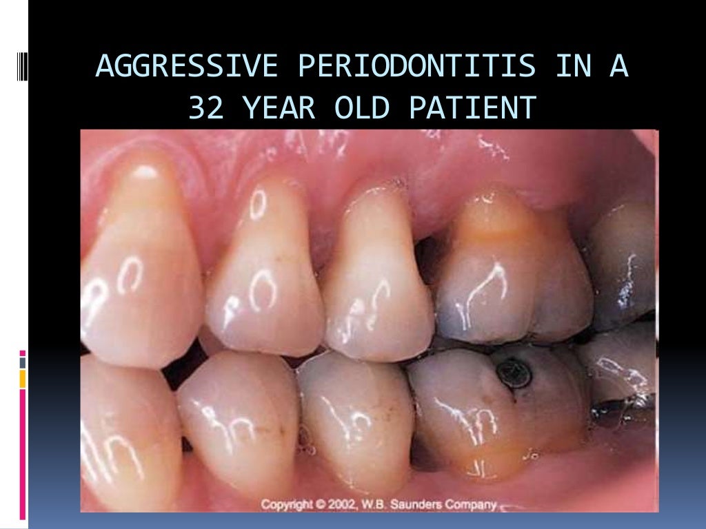 Aggressive periodontitis