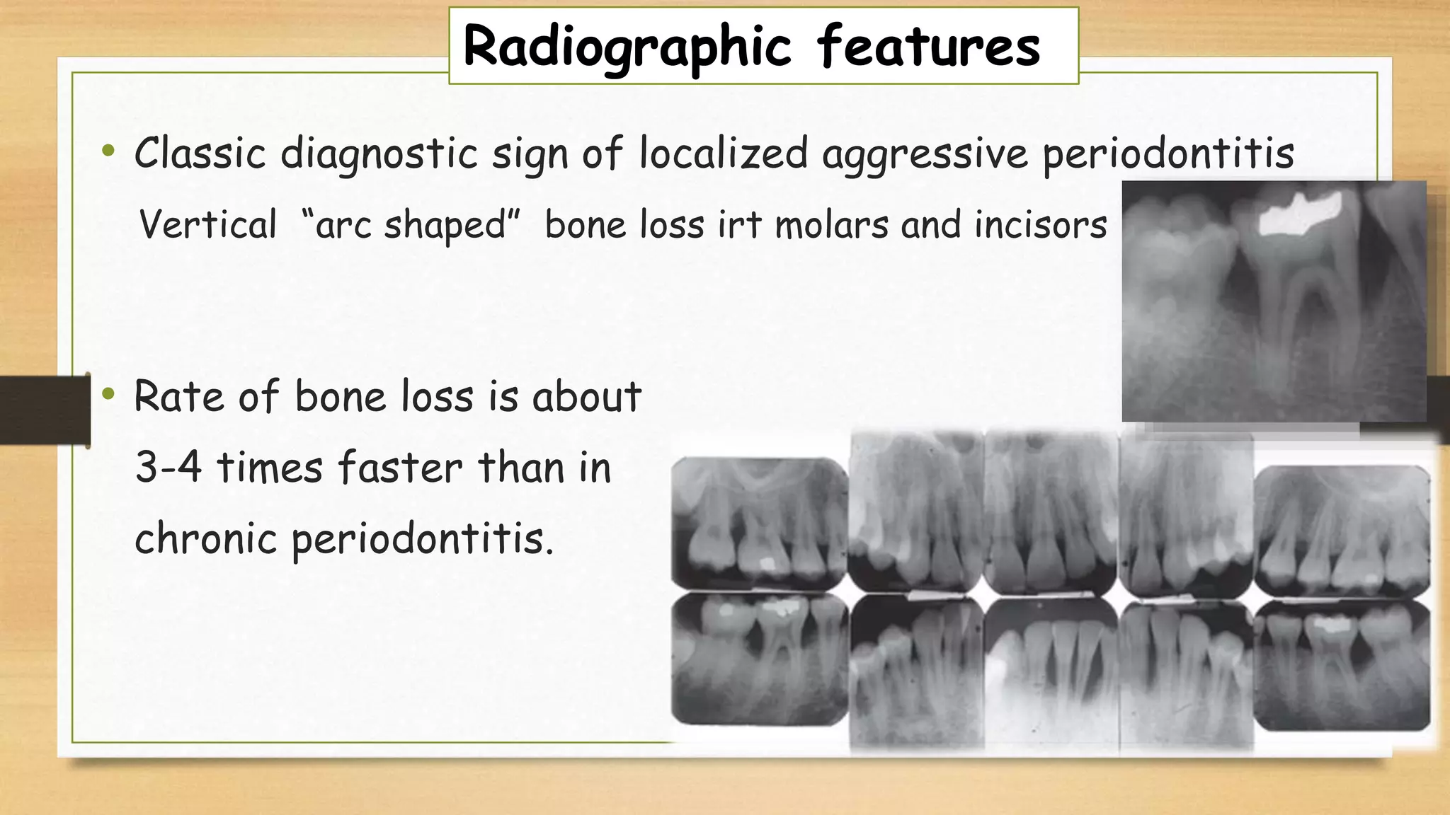 Aggressive periodontitis | PPTX