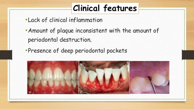 Aggressive periodontitis