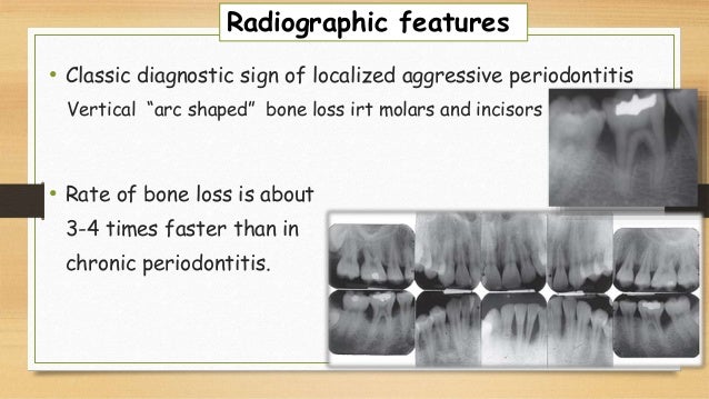 Aggressive periodontitis