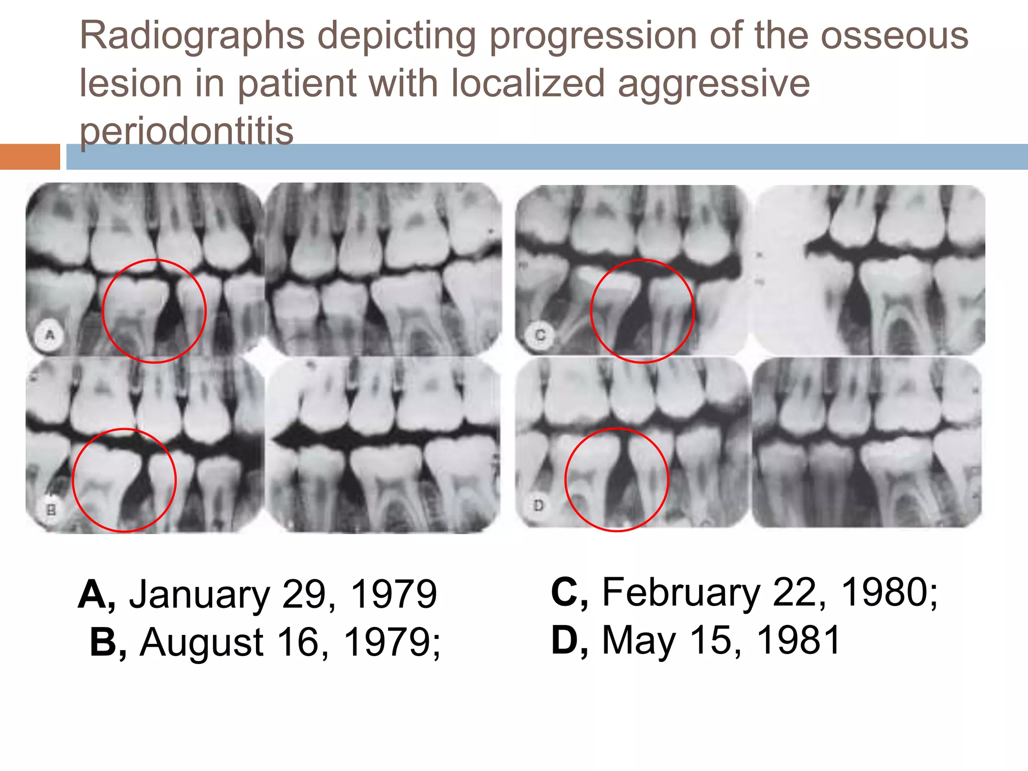 Aggressive periodontitis | PPTX