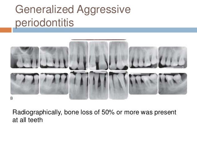 Aggressive periodontitis