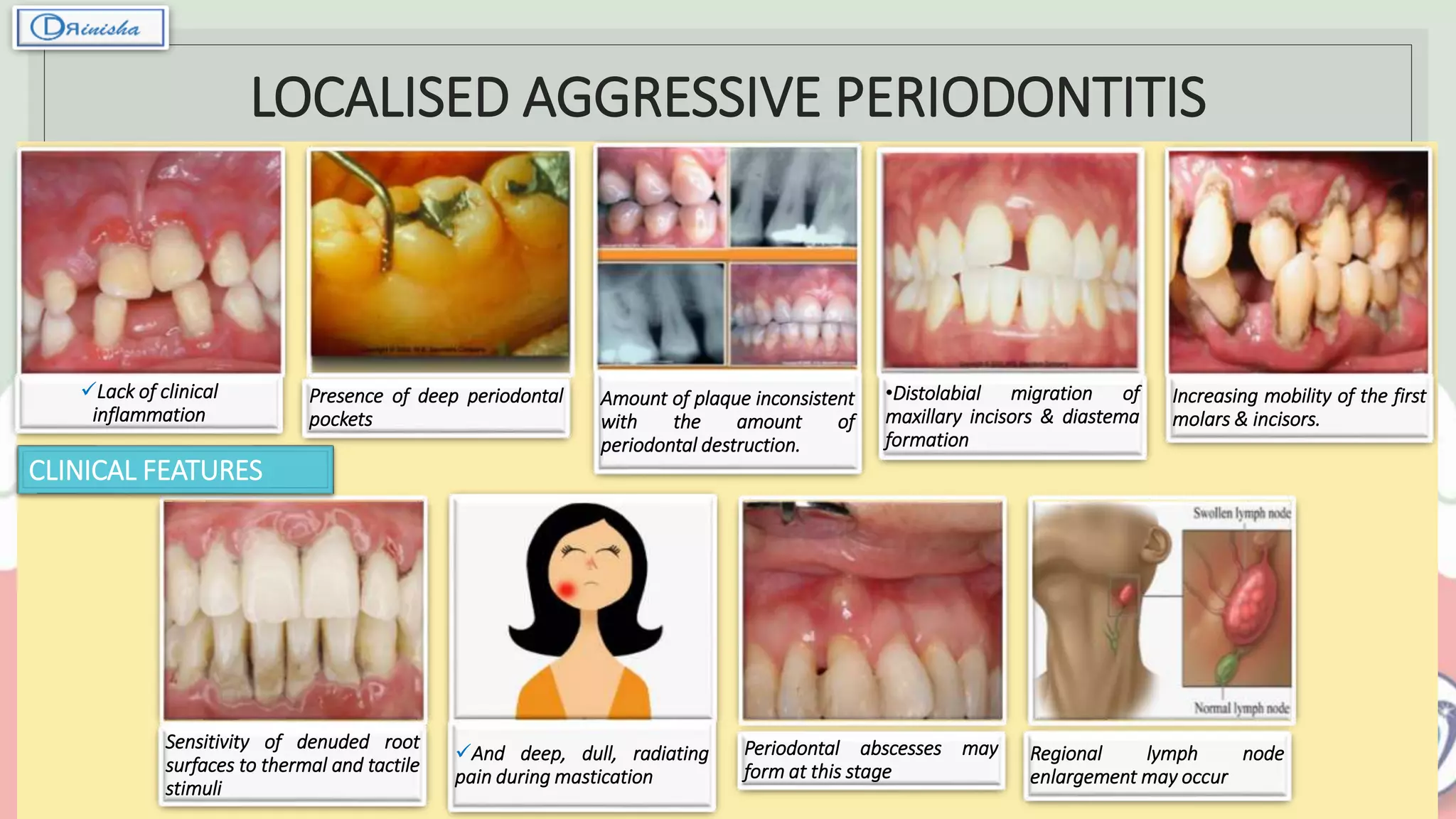 Aggressive periodontitis | PPTX