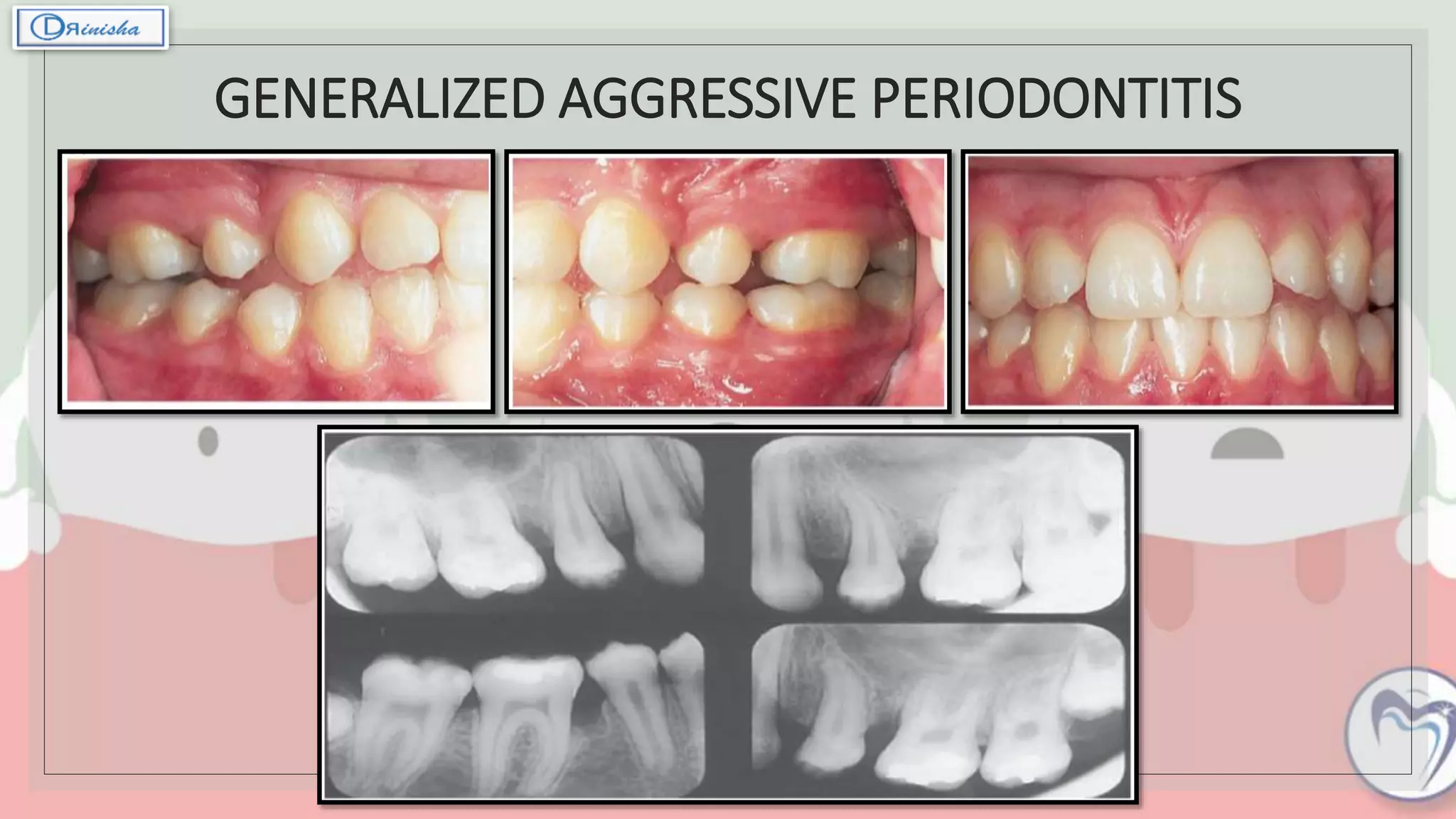 Aggressive periodontitis | PPTX