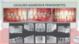 Aggressive periodontitis | PPTX