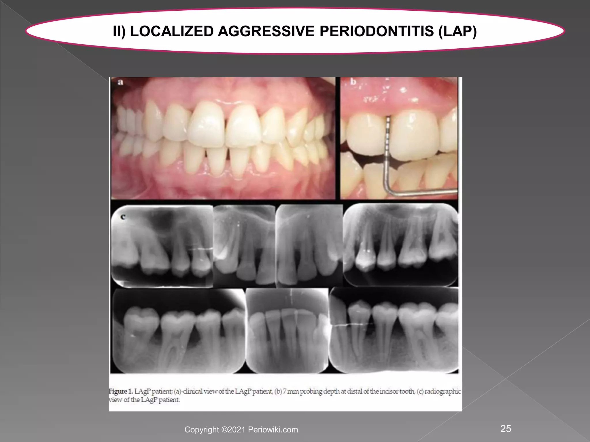 Aggressive periodontitis | PPTX