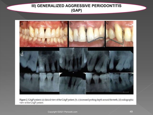 Aggressive periodontitis | PPT