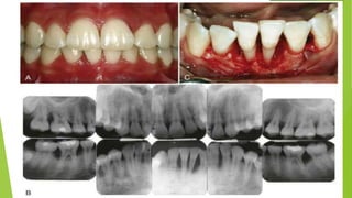 Aggressive periodontitis | PPTX