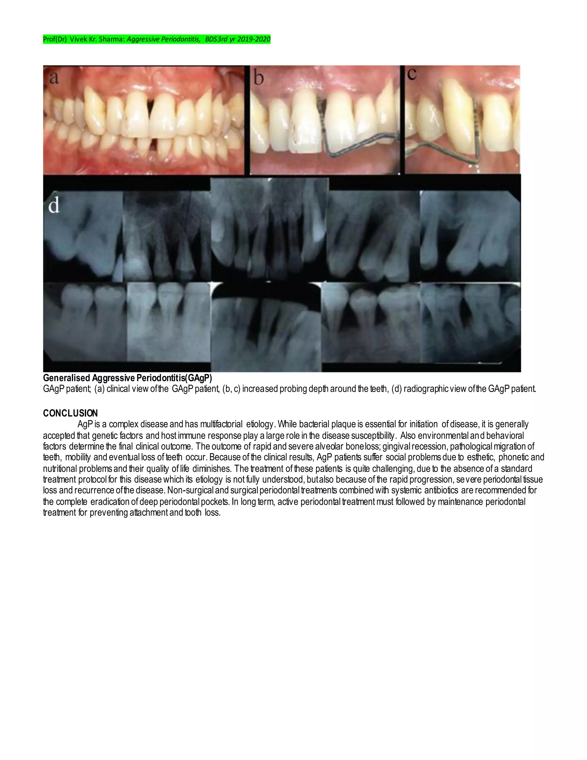 Aggressive periodontitis | PDF