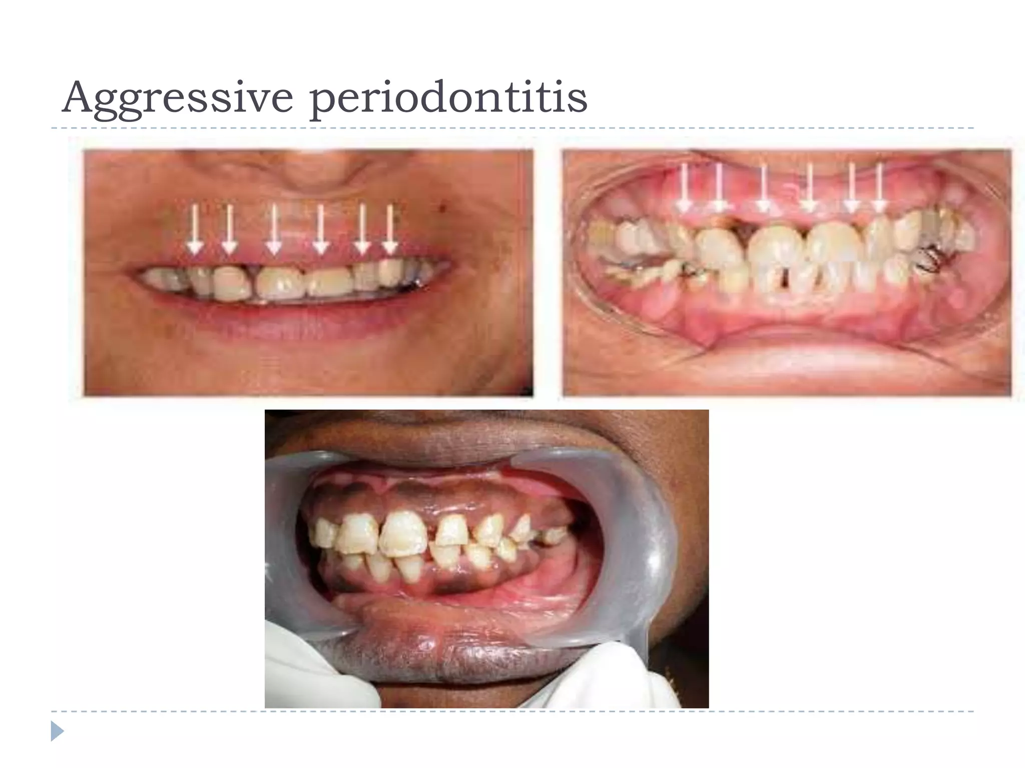 Aggressive periodontitis 3 | PPTX