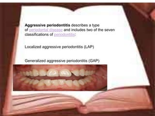 Aggressive periodontitis 3 | PPTX