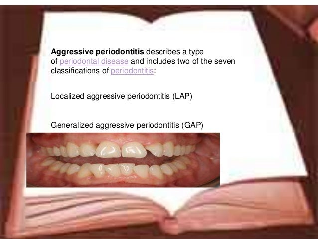 Aggressive periodontitis 3