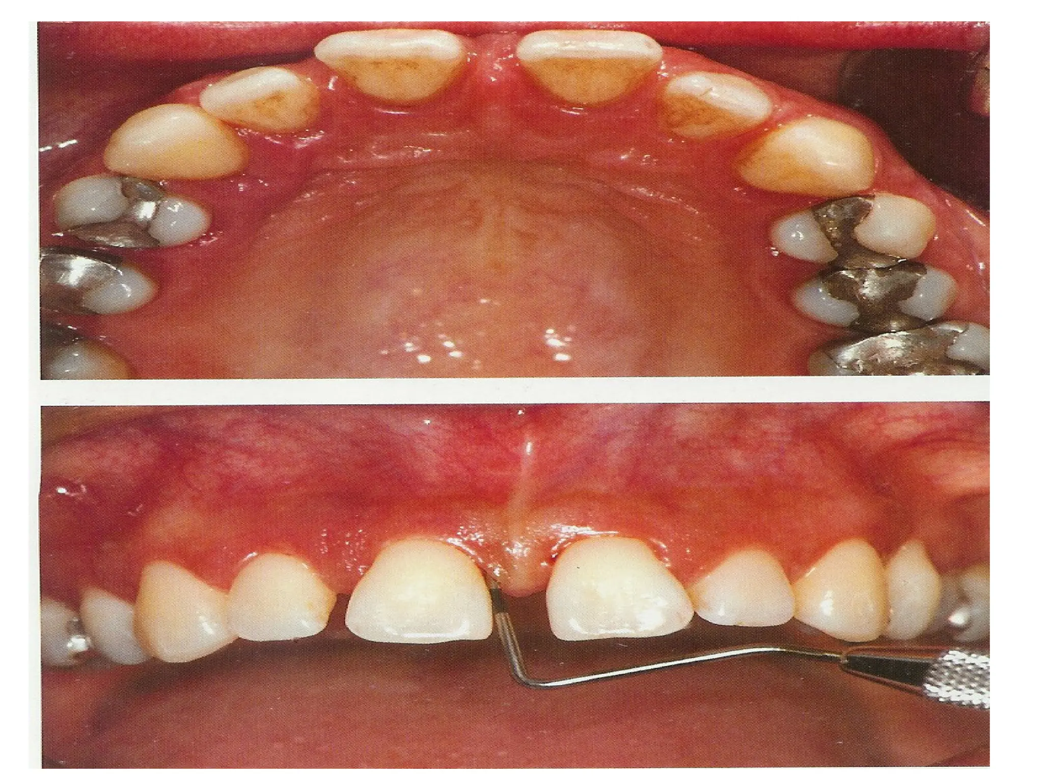 Aggressive Periodontitis ( Early Onset Periodontitis).pptx