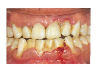 Aggressive Periodontitis ( Early Onset Periodontitis).pptx