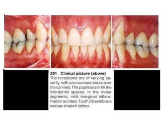 Aggressive Periodontitis ( Early Onset Periodontitis).pptx