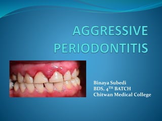 Aggressive periodontitis | PPTX | Dental Health | Diseases and Conditions